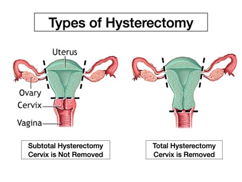 Total Hysterectomy Vs Supracervical Hysterectomy Which Is Right Total Hysterectomy Vs Supracervical Hysterectomy Which Is Right